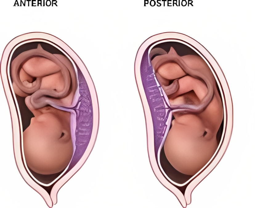 Posterior Placenta The Ultimate Guide To A Healthy And Happy Pregnancy