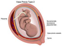 Vasa Previa: A Rare but Manageable Condition with a High Survival Rate in 2023